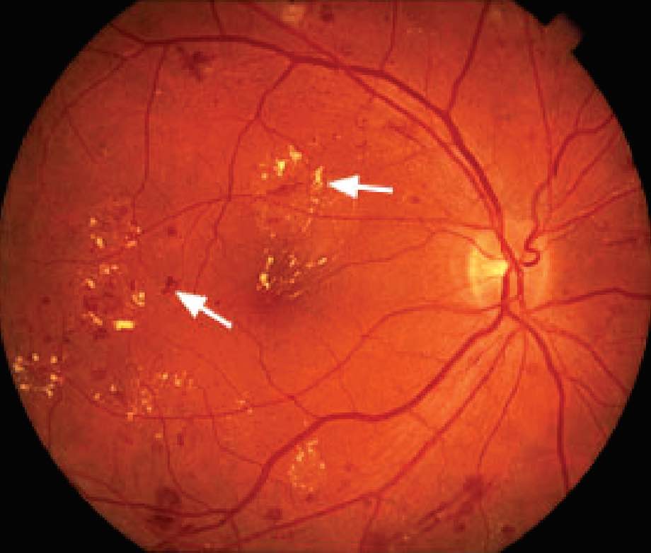 Diabetic Retinopathy OPTIMAX Eye Specialist Malaysia
